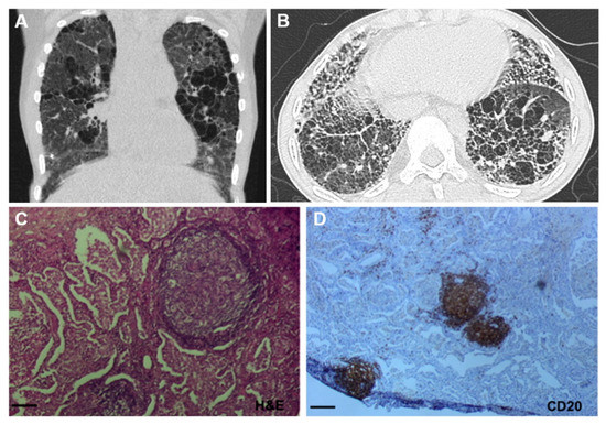 Lung Inflammation in STING-Associated Vasculopathy with Onset in ...