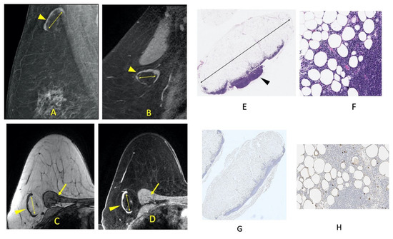 Decrease in the Size of Fat-Enlarged Axillary Lymph Nodes and Serum ...