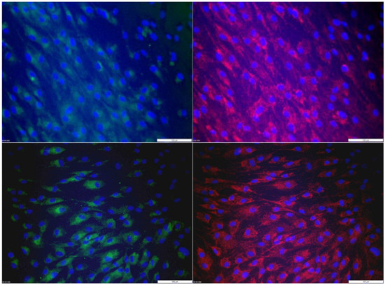 Clinical Heterogeneity in MT-ATP6 Pathogenic Variants: Same Genotype ...