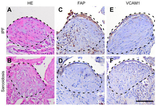Comparative Analysis of Gene Expression in Fibroblastic Foci in ...