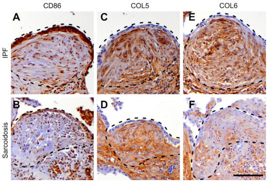 Comparative Analysis of Gene Expression in Fibroblastic Foci in ...