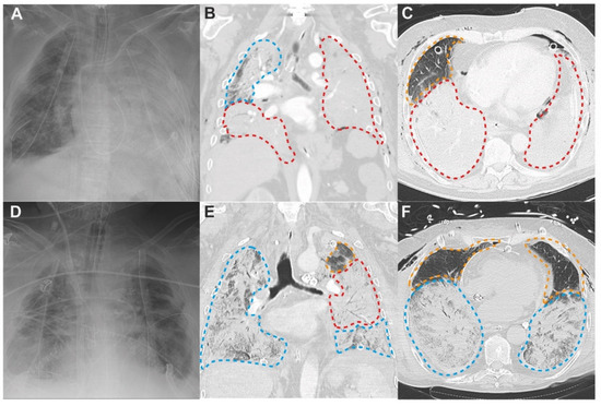 A Focused Review on Primary Graft Dysfunction after Clinical Lung ...