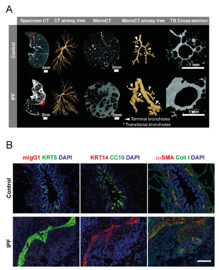 Emerging Roles of Airway Epithelial Cells in Idiopathic Pulmonary Fibrosis
