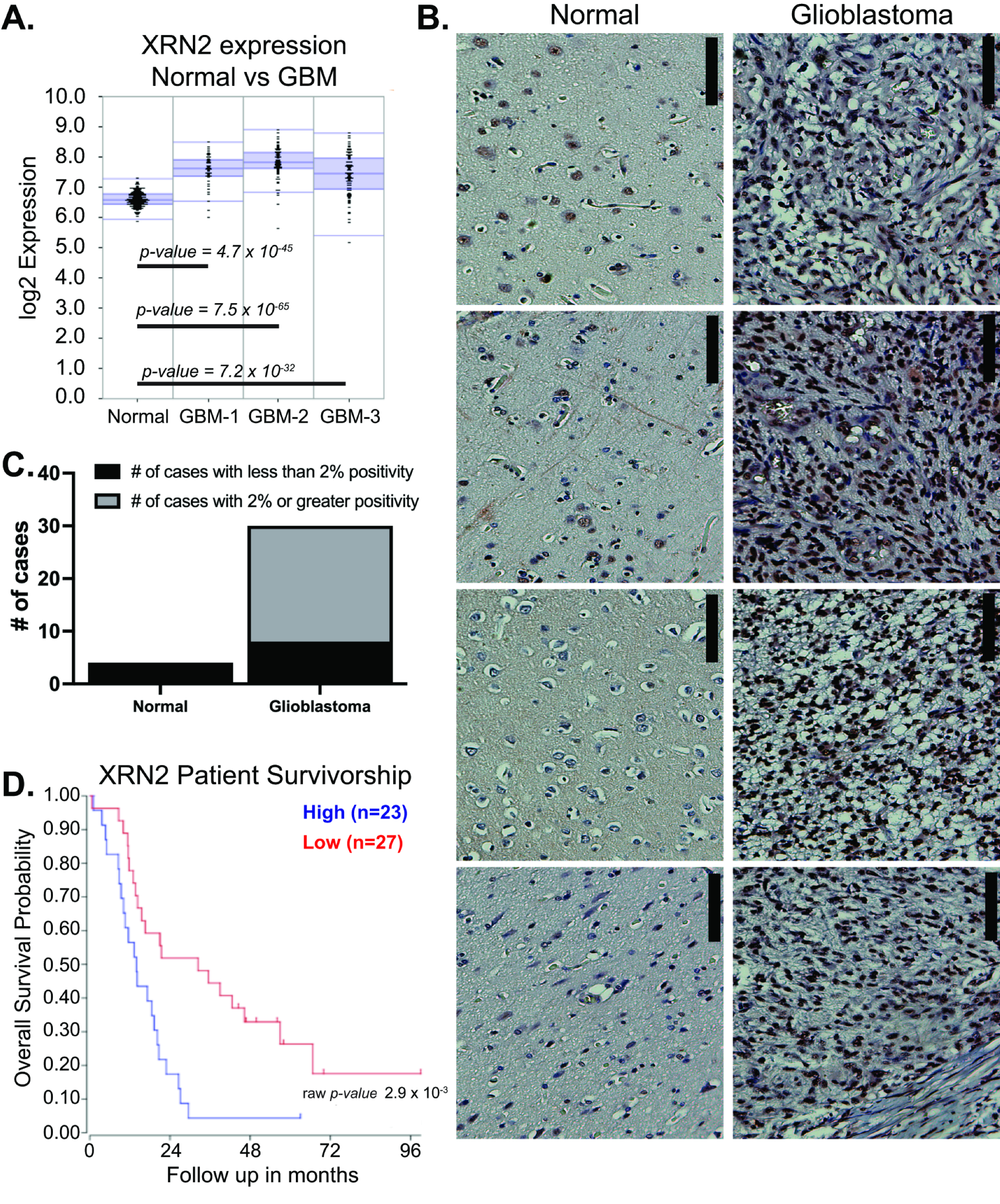 XRN2 Is Required for Cell Motility and Invasion in Glioblastomas XRN2 Is Required for Cell Motility and Invasion in Glioblastomas