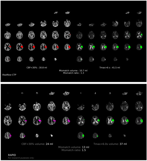 Comparison of Two Software Packages for Perfusion Imaging: Ischemic ...