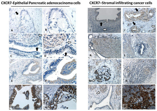 CXCR4-CXCL12-CXCR7 and PD-1/PD-L1 in Pancreatic Cancer: CXCL12 Predicts Survival of Radically ...