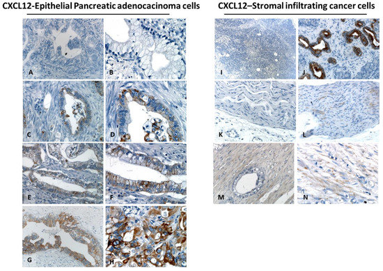 CXCR4-CXCL12-CXCR7 and PD-1/PD-L1 in Pancreatic Cancer: CXCL12 Predicts Survival of Radically ...