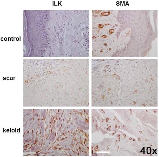 The Role of Hippo Signaling Pathway and ILK in the Pathophysiology of ...