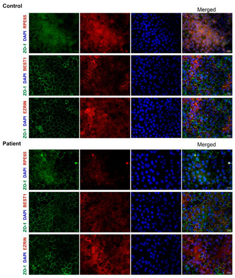 The Predicted Splicing Variant c.11+5G>A in RPE65 Leads to a Reduction ...