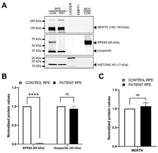 The Predicted Splicing Variant c.11+5G>A in RPE65 Leads to a Reduction ...