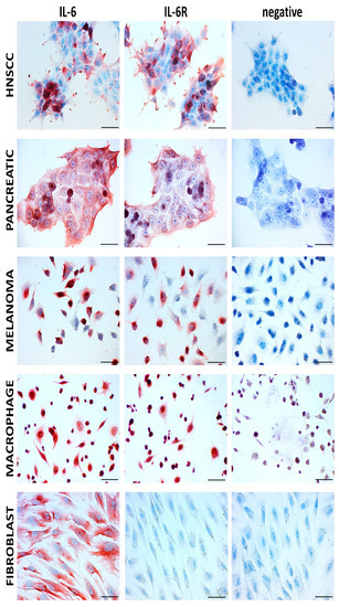 The Role of IL-6 in Cancer Cell Invasiveness and Metastasis—Overview ...