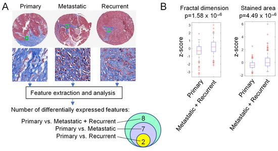 Dynamic Changes in the Extracellular Matrix in Primary, Metastatic, and Recurrent Ovarian Cancers