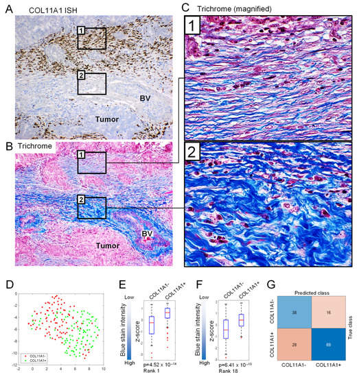 Dynamic Changes in the Extracellular Matrix in Primary, Metastatic, and Recurrent Ovarian Cancers