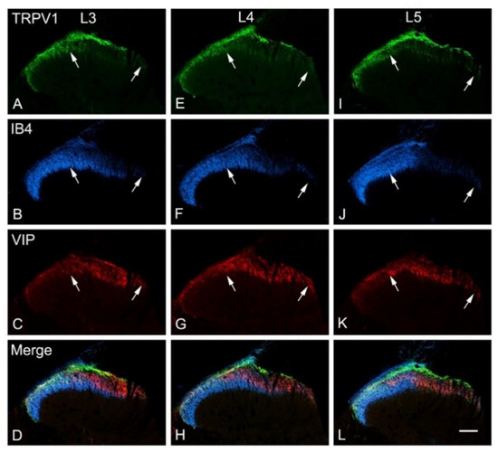 Cutaneous Injection of Resiniferatoxin Completely Alleviates and ...