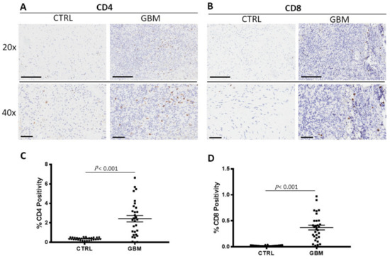 Tumor Microenvironment and Microvascular Density in Human Glioblastoma
