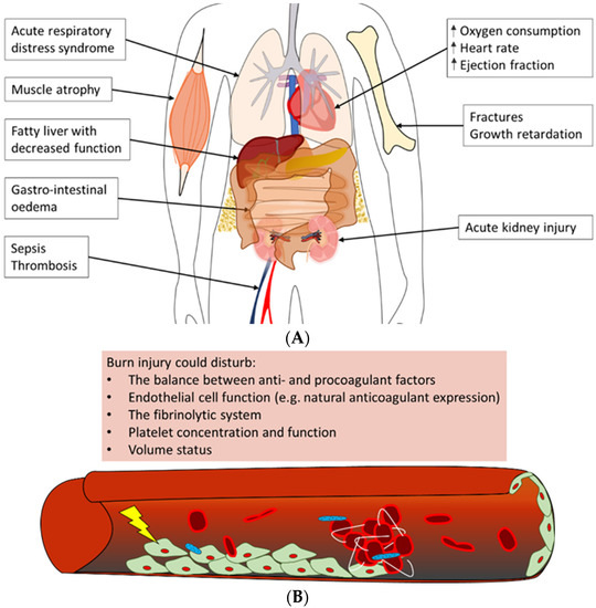 The Complexity of the Post-Burn Immune Response: An Overview of the ...