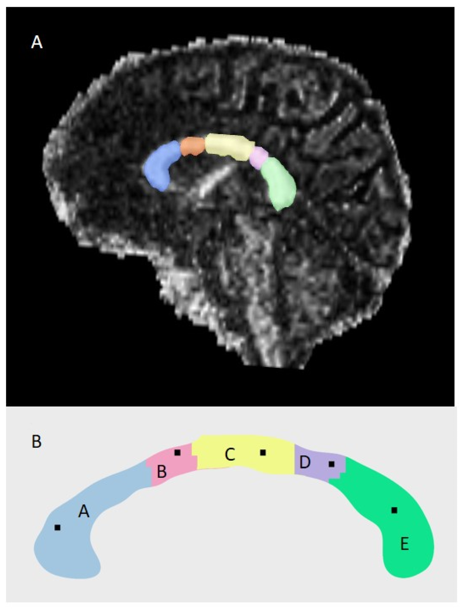 Microstructural Changes in the Corpus Callosum in Systemic Lupus ...