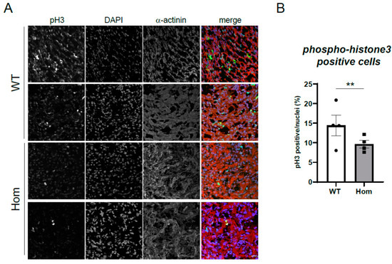 Insights into the Role of a Cardiomyopathy-Causing Genetic Variant in ACTN2