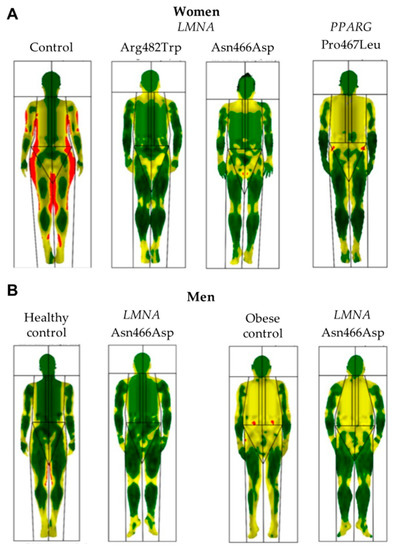 Clinical Spectrum of LMNA-Associated Type 2 Familial Partial ...
