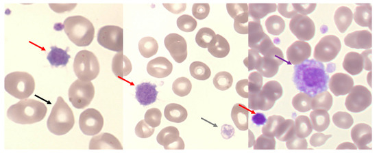 Cytological Diagnosis of Classic Myeloproliferative Neoplasms at the Age of Molecular Biology