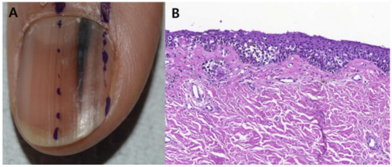 Adult and Pediatric Nail Unit Melanoma: Epidemiology, Diagnosis, and ...
