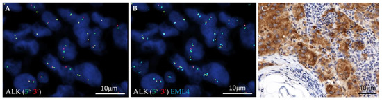Gene Fusion Detection in NSCLC Routine Clinical Practice: Targeted-NGS ...