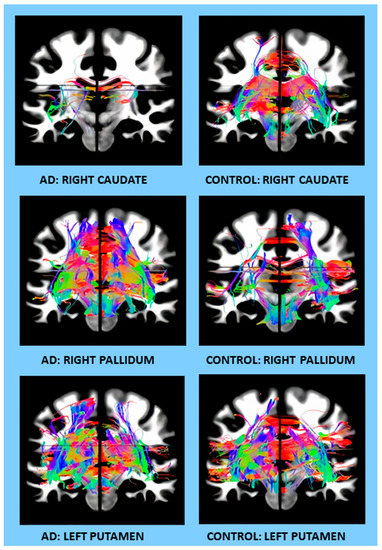 Basal Ganglia Compensatory White Matter Changes on DTI in Alzheimer’s Disease