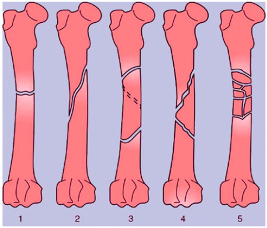 Three-Dimensional Bioprinting Applications for Bone Tissue Engineering