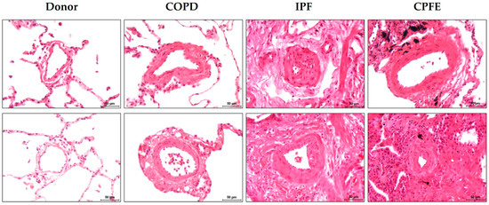 Combined Pulmonary Fibrosis and Emphysema: When Scylla and Charybdis Ally