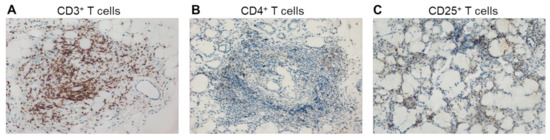 The Role of Regulatory T Cells in the Onset and Progression of Primary ...