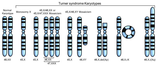 Organ Abnormalities Caused by Turner Syndrome