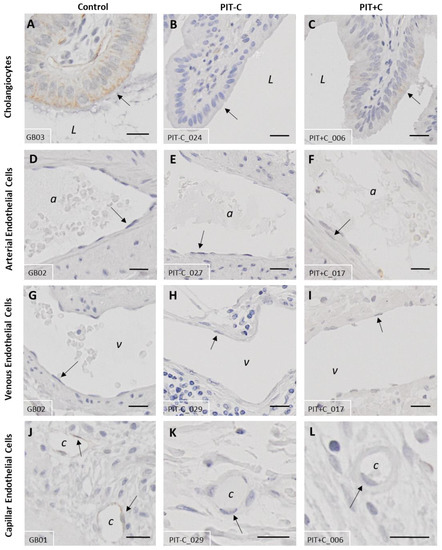 Galanin System in the Human Bile Duct and Perihilar Cholangiocarcinoma