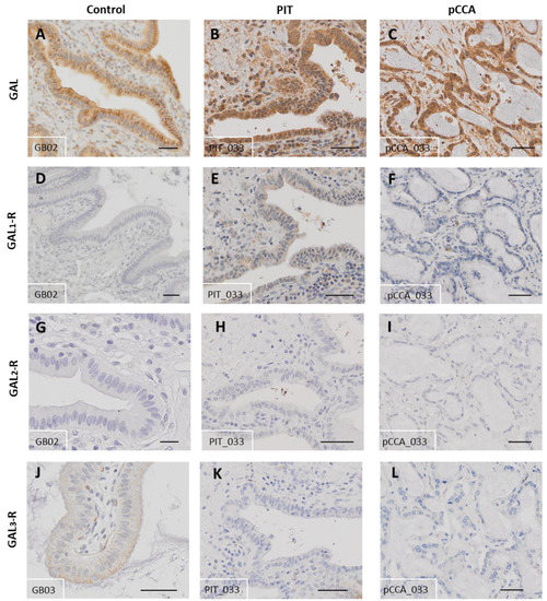 Galanin System in the Human Bile Duct and Perihilar Cholangiocarcinoma