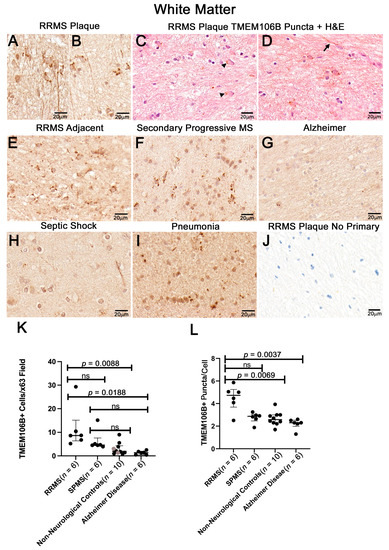 TMEM106B Puncta Is Increased in Multiple Sclerosis Plaques, and Reduced ...