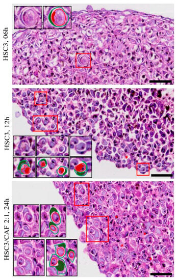 Cells | Free Full-Text | Mapping Cell-in-Cell Structures in Oral ...
