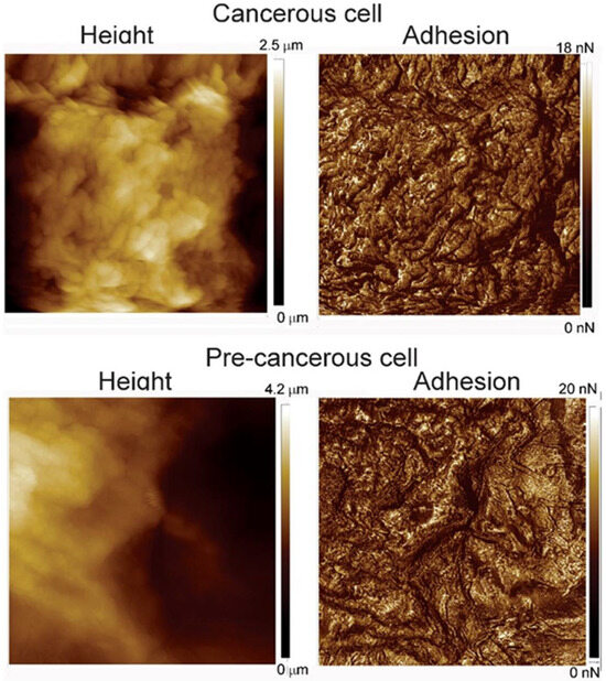 Machine Learning Allows for Distinguishing Precancerous and Cancerous ...