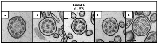 Ciliary Ultrastructure Assessed by Transmission Electron Microscopy in ...