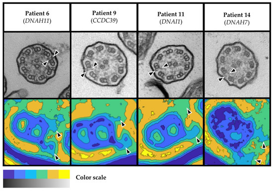 Ciliary Ultrastructure Assessed by Transmission Electron Microscopy in ...