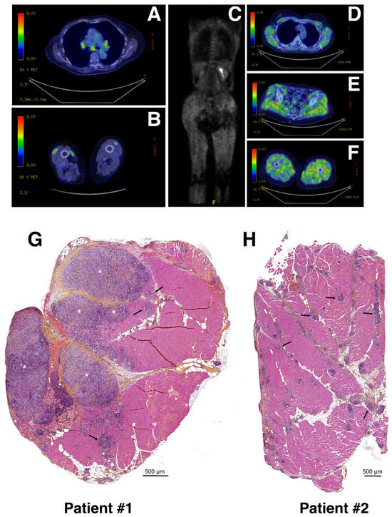 Cells | Free Full-Text | Spatial Transcriptomics Reveals Signatures of ...