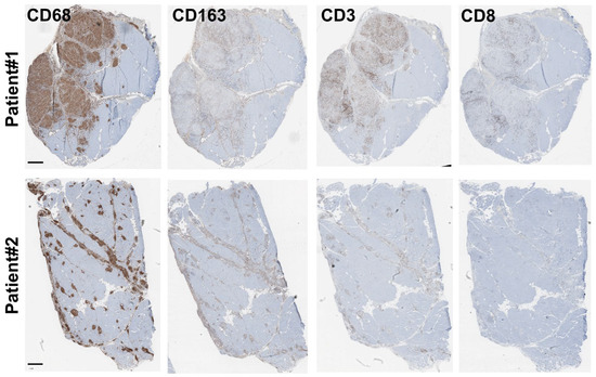 Cells | Free Full-Text | Spatial Transcriptomics Reveals Signatures of ...