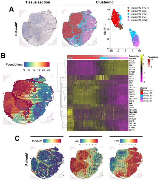 Cells | Free Full-Text | Spatial Transcriptomics Reveals Signatures of ...