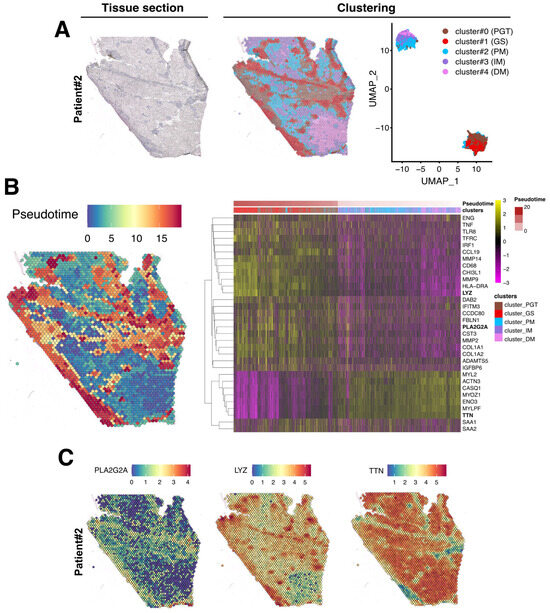 Cells | Free Full-Text | Spatial Transcriptomics Reveals Signatures of ...