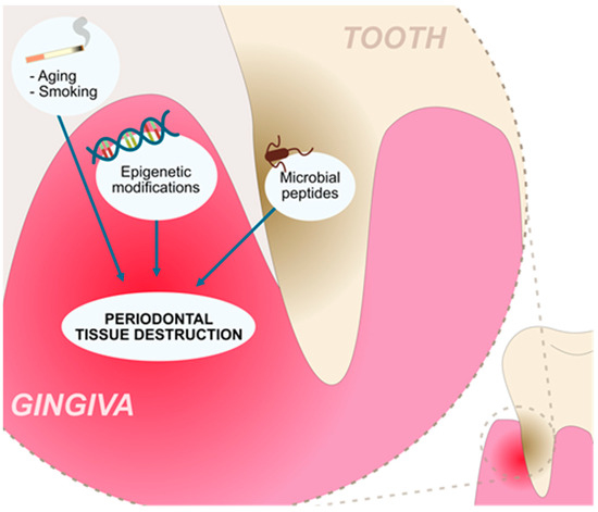 The Genetic Aspects of Periodontitis Pathogenesis and the Regenerative ...