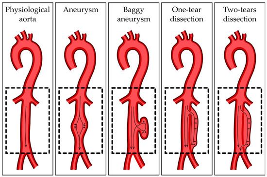 Cellular, Molecular and Clinical Aspects of Aortic Aneurysm—Vascular ...