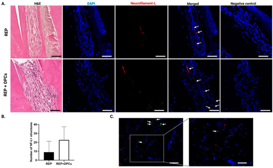 Dental Pulp Cell Transplantation Combined with Regenerative Endodontic ...