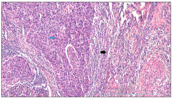 Lung Cancers: Parenchymal Biochemistry and Mechanics