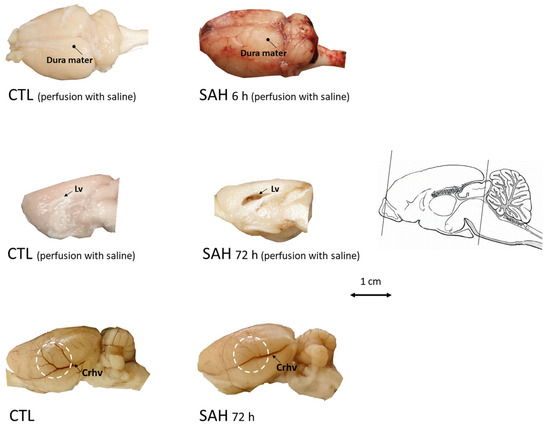 Subarachnoid Hemorrhage Depletes Calcitonin Gene-Related Peptide Levels ...