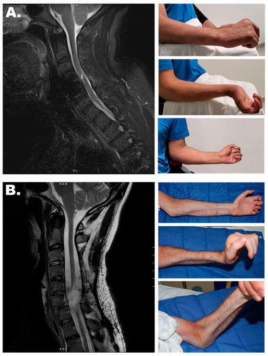Novel Technologies to Address the Lower Motor Neuron Injury and Augment ...