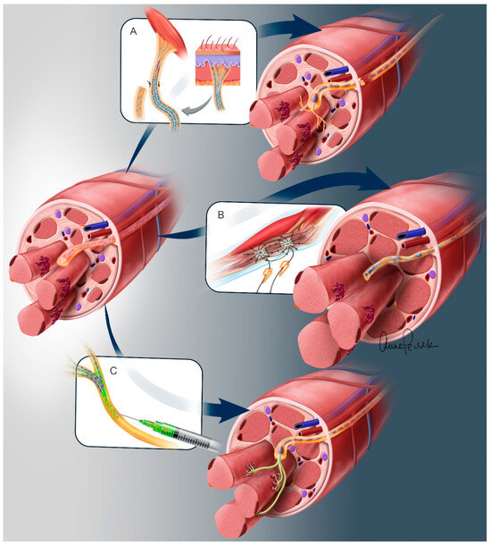Novel Technologies to Address the Lower Motor Neuron Injury and Augment ...