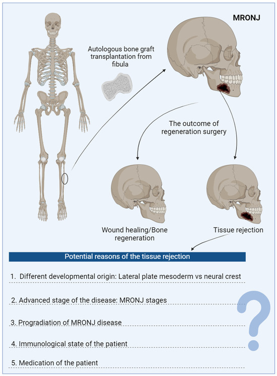 Advancements in Bone Replacement Techniques–Potential Uses After ...